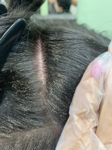 Lice During Pregnancy: Safe and Natural Treatment Options | Lice ...