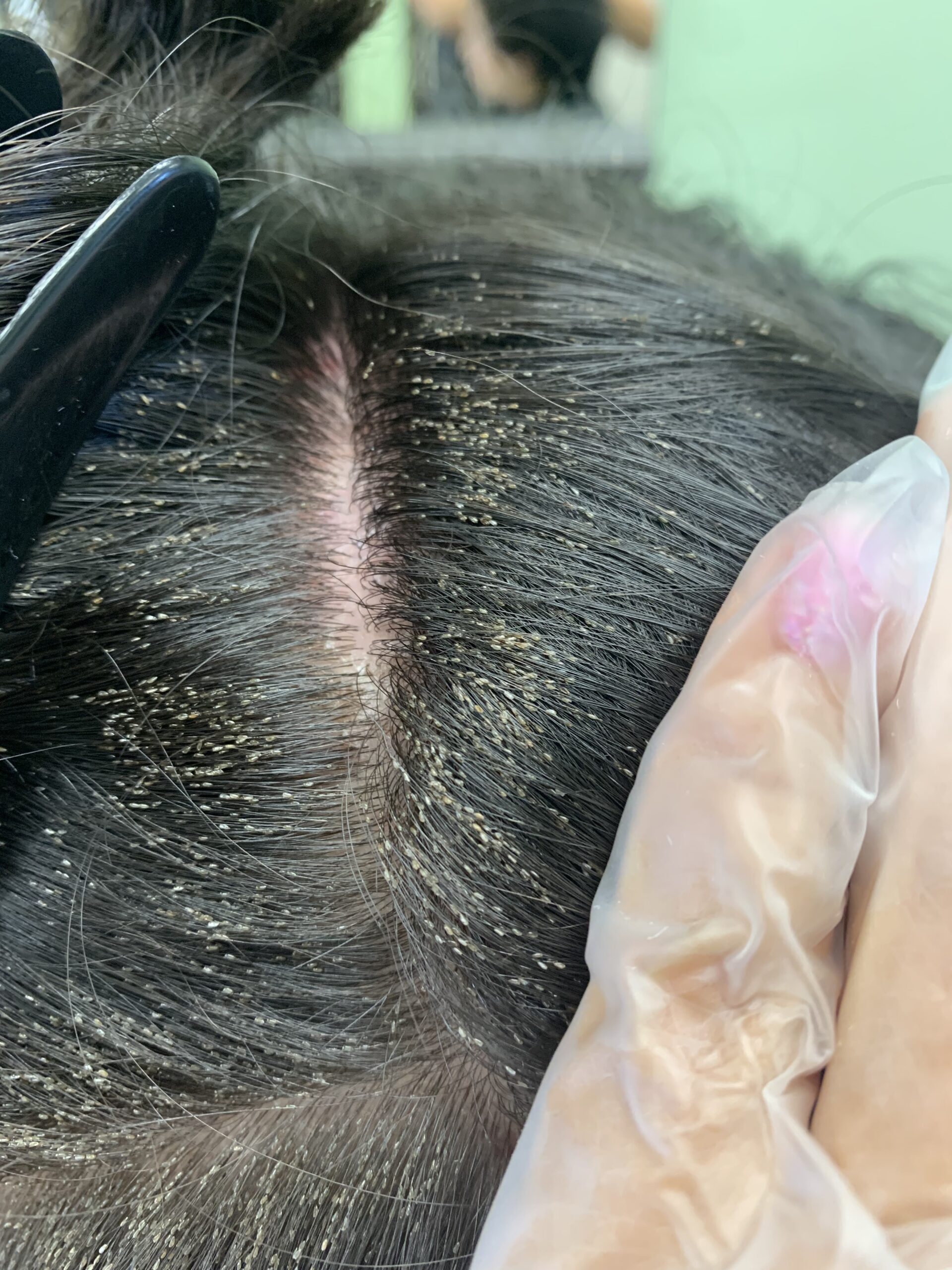 How to Get Rid of Lice: No Stress Guide | Lice Removal Network