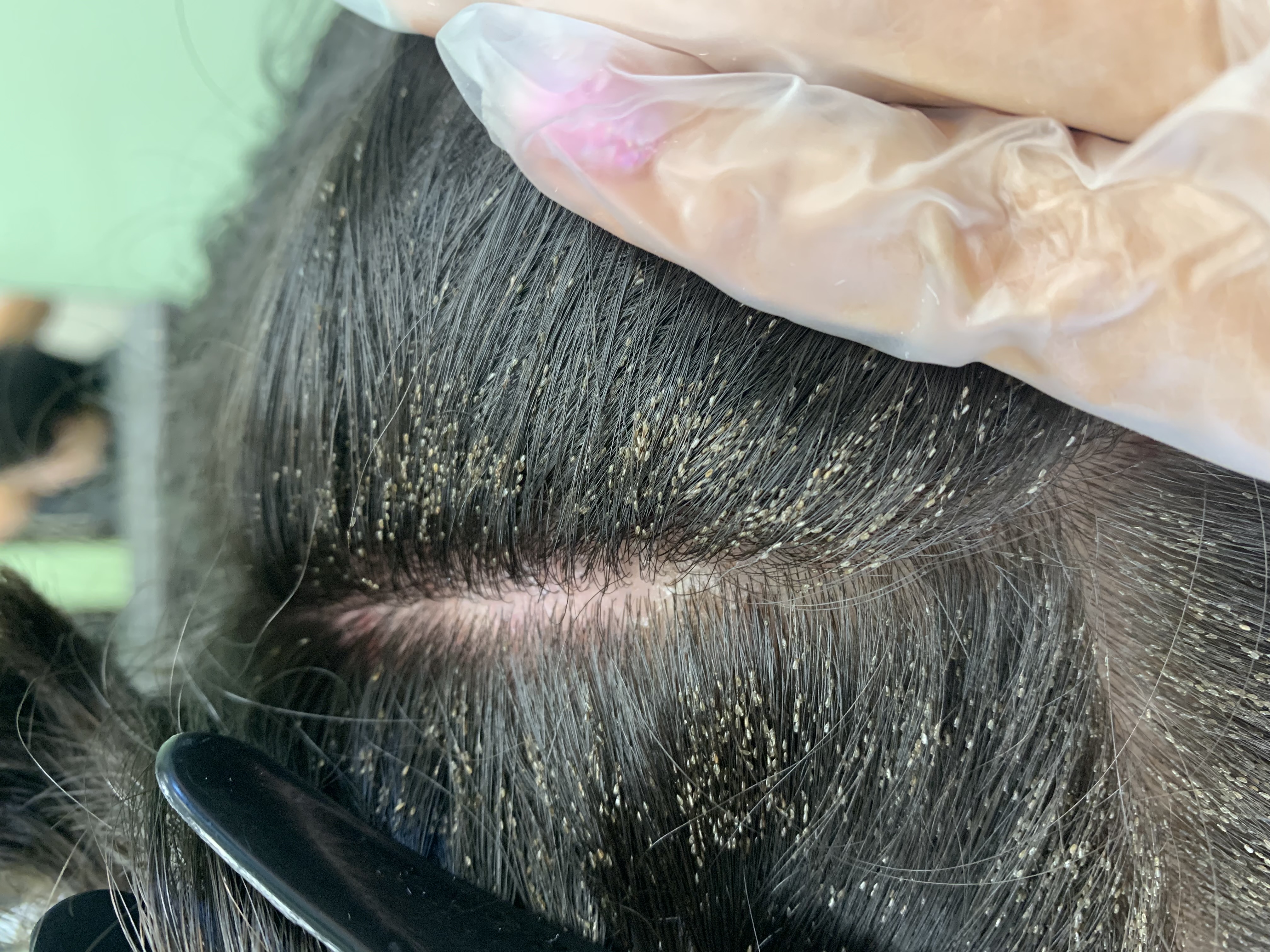 How to Check for Lice | Lice Removal Network